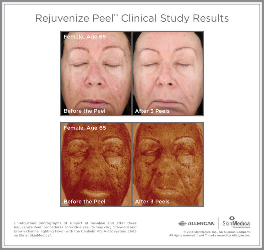 Peels (SKINMEDICA) – Rejuvenations Laser Center & Medical Spa