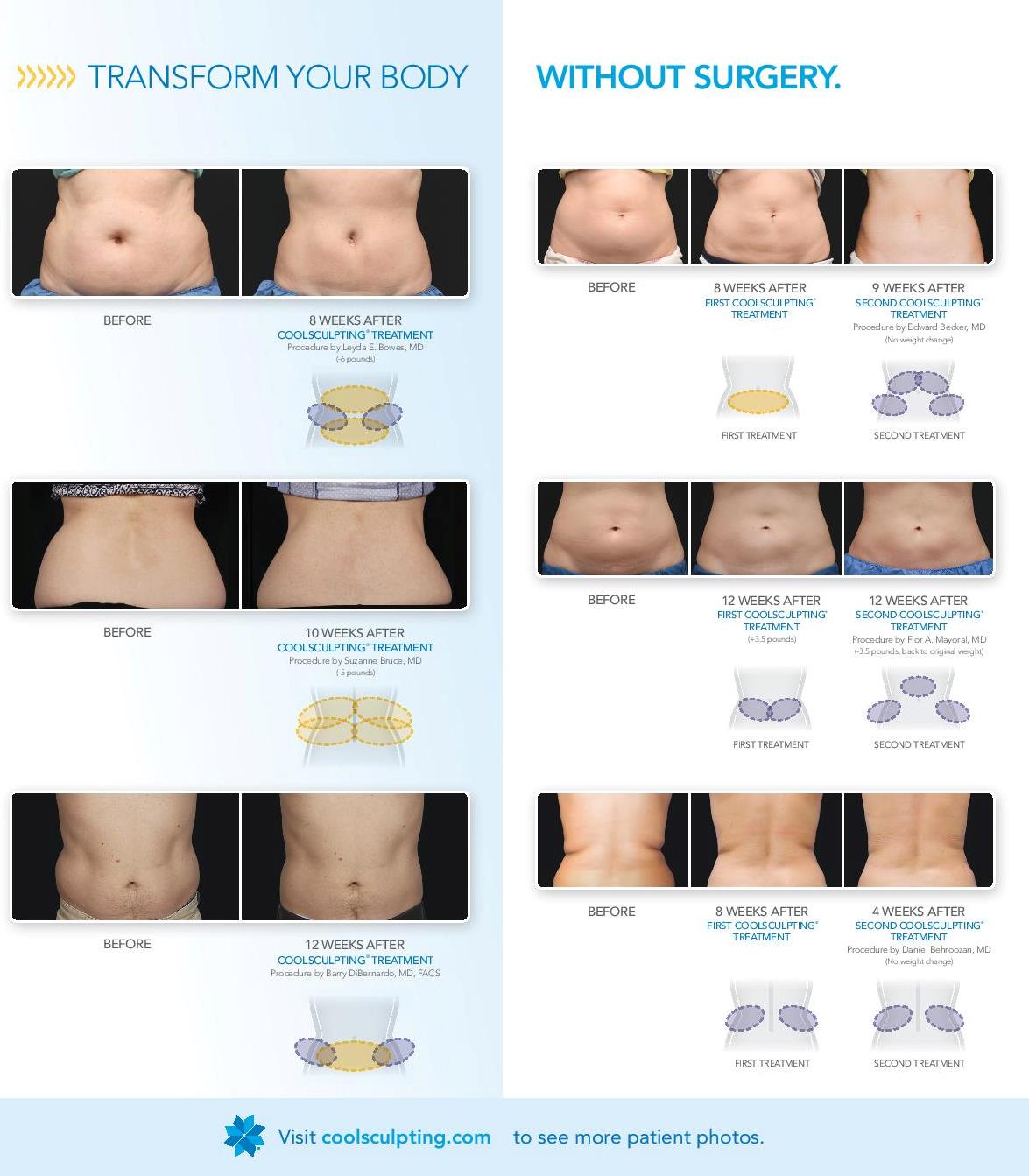 CoolSculpting® – Rejuvenations Laser Center & Medical Spa