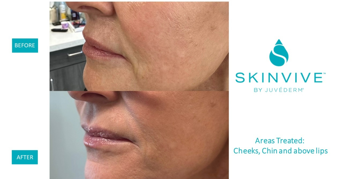 Skinvive by juvederm - Rejuvenations Laser Center & Medical Spa
